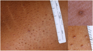 Pelos encravados - Dermatologia e Saude