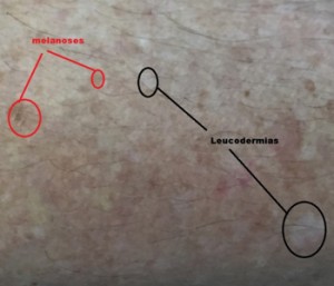 Leucodermias solares - Dermatologia e Saúde
