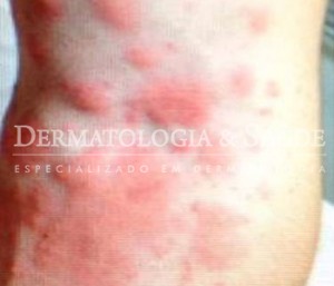 Prurido - Dermatologia e Saúde