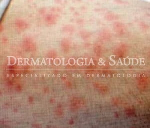 Prurido - Dermatologia e Saúde