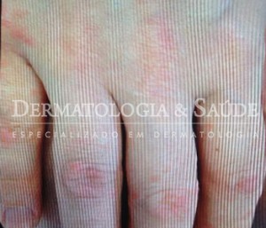 Prurido - Dermatologia e Saúde