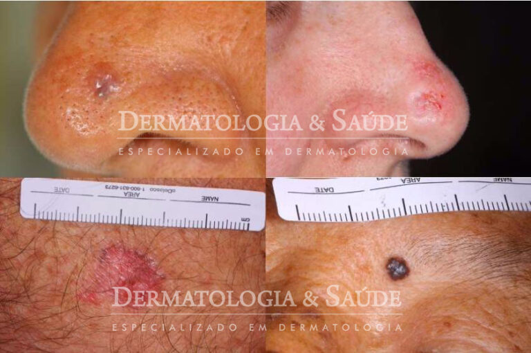 Carcinomas Basocelulares e Suas Diversas Formas Clínicas