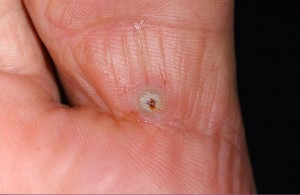 Bicho de pé (Tungíase) - Dermatologia e Saude