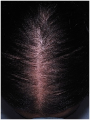 Queda de cabelos – Eflúvio telógeno - Dermatologia e Saúde