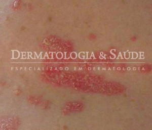 Psoríase - Dermatologia e Saude