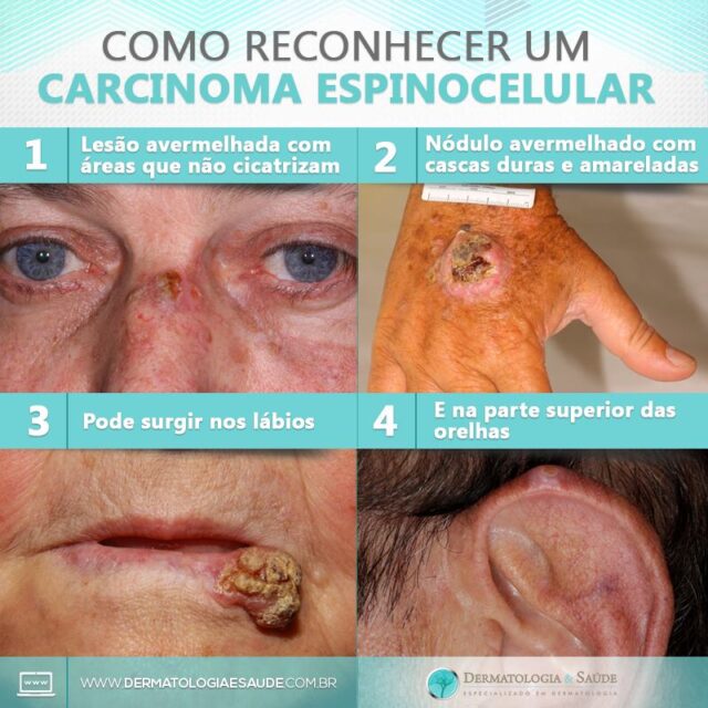 Como reconhecer um carcinoma espinocelular - Dermatologia e Saude