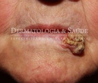 Como reconhecer um carcinoma espinocelular - Dermatologia e Saúde