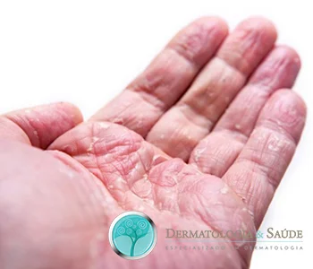 Disidrose - Dermatologia e Saude
