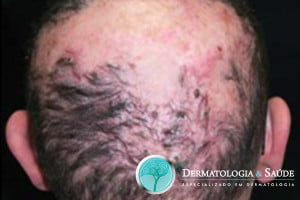 Foliculite Decalvante - Dermatologia e Saude