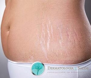 Como surgem as estrias - Dermatologia e Saúde