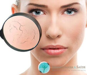 O que é pele atópica? - Dermatologia e Saúde