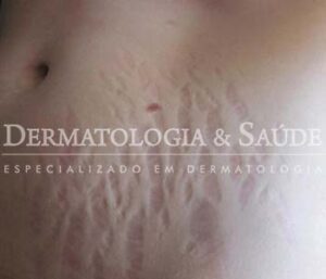Os Melhores Tratamentos para Estrias