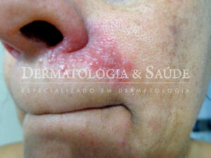 Tenho bolinhas avermelhadas ao redor da boca. O que pode ser?