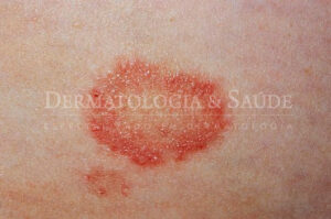 O que você tem? Doutor, eu tenho impinge.