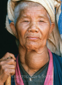 Papeira? O que é isso?