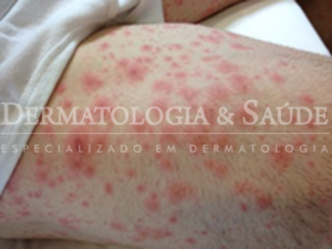 Eu tenho eritema multiforme e quero saber mais